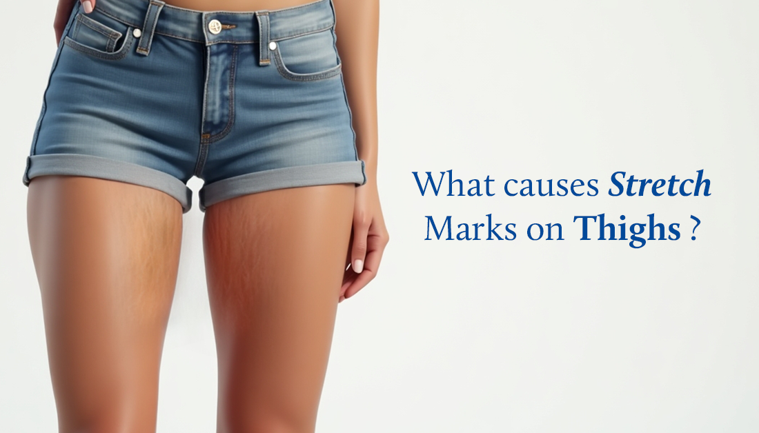 Understanding Stretch Marks on Thighs: Causes, Types, and Remedies ...