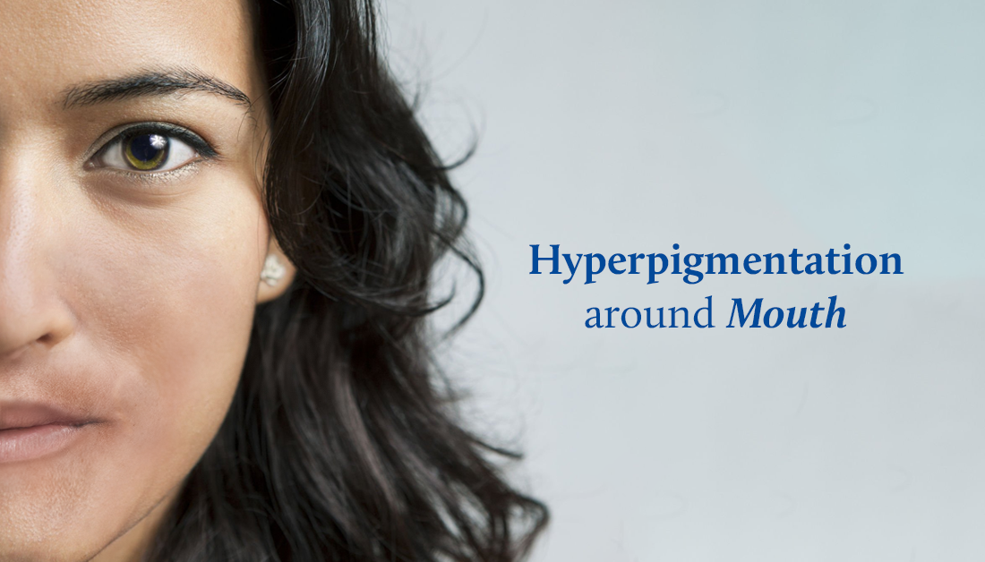 Preventing and Treating Hyperpigmentation Around Mouth – Blue Nectar